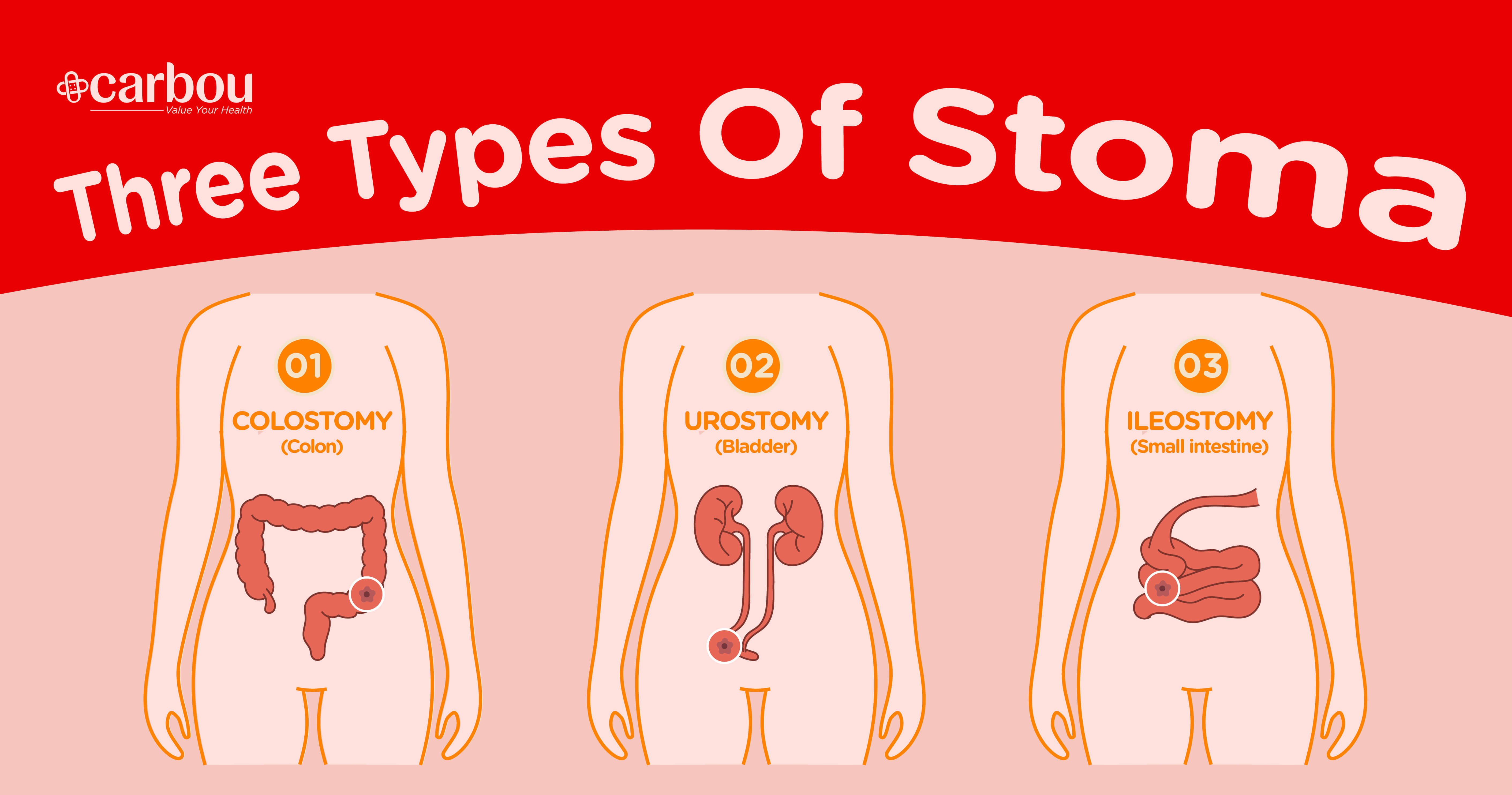 What Is an Ostomy? A Simple Guide for New Ostomy Patients – Carbou