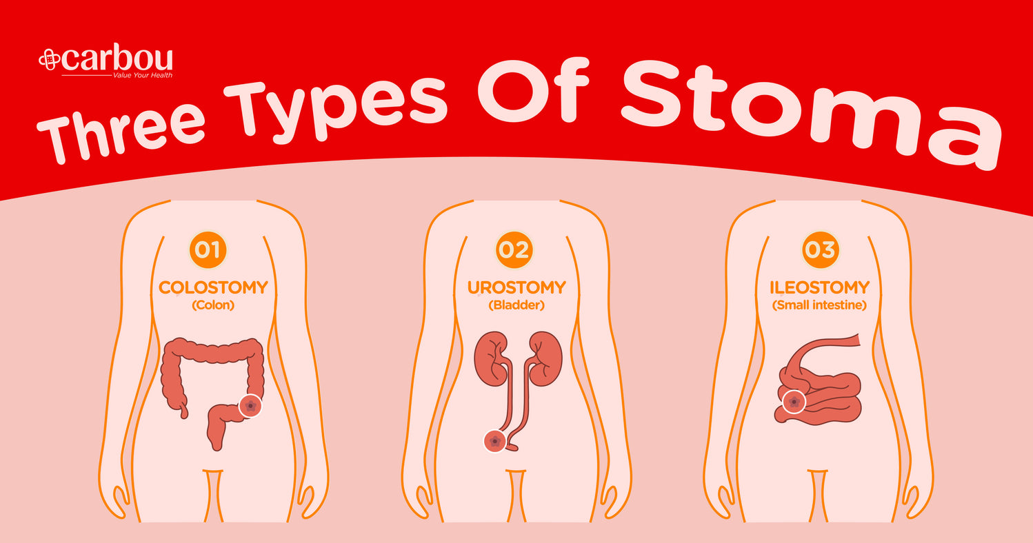 What Is an Ostomy? A Simple Guide for New Ostomy Patients – Carbou